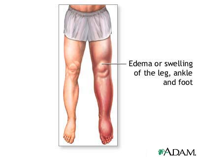 Lower Leg Edema MedlinePlus Medical Encyclopedia Image Lower Leg Edema MedlinePlus Medical Encyclopedia Image