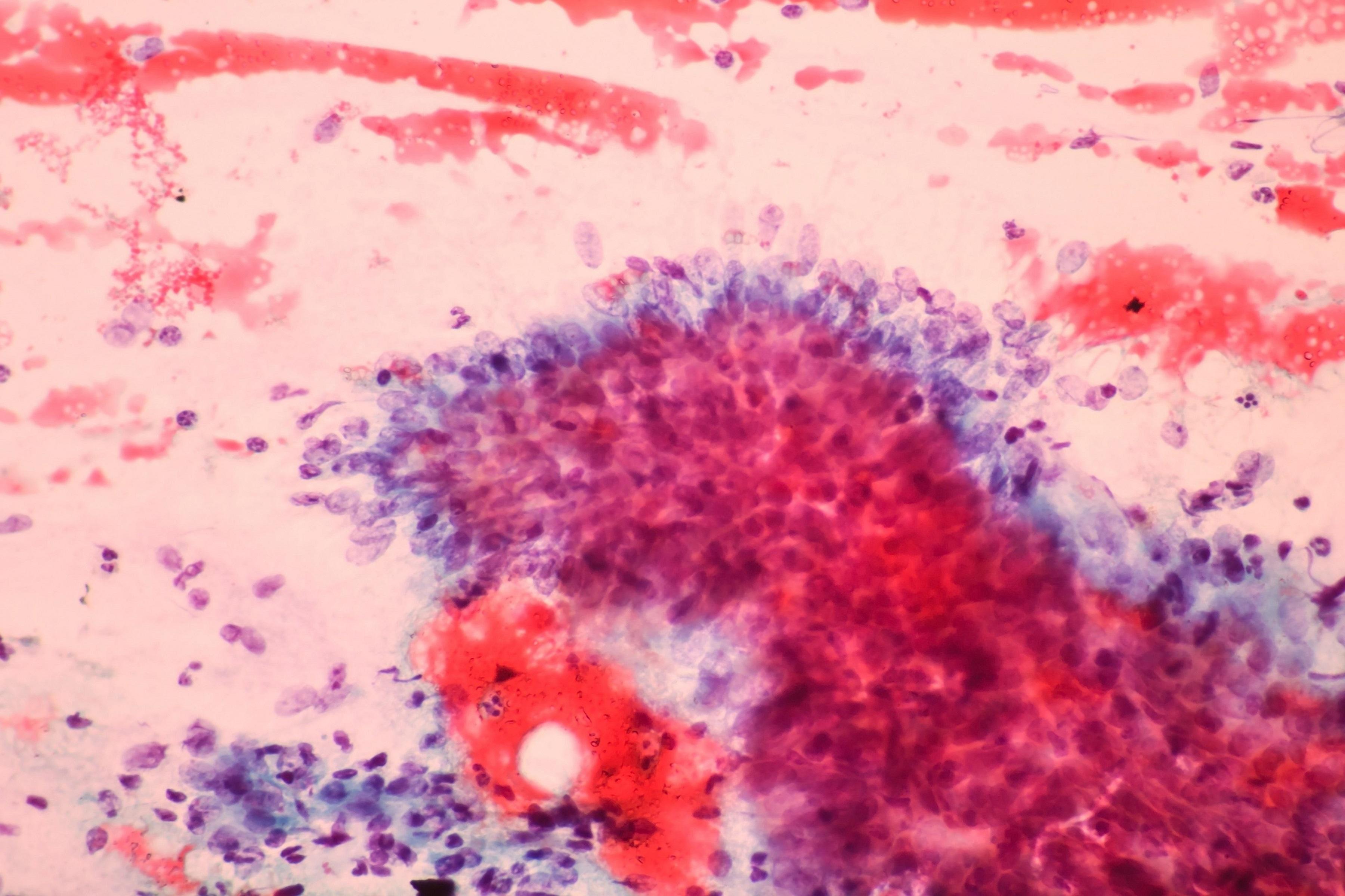 Cervical Cancer | HPV | Human Papillomavirus | MedlinePlus