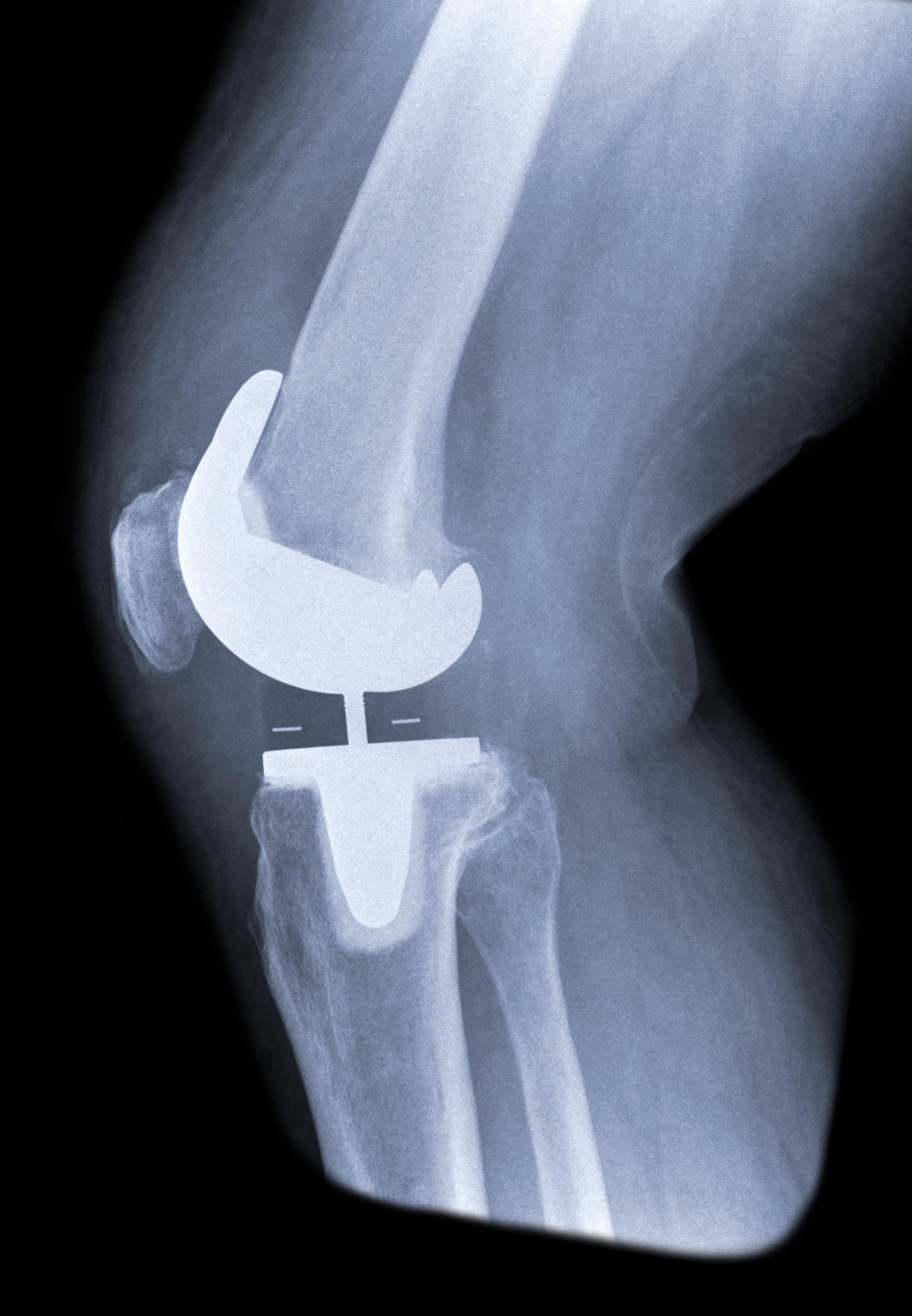 Knee Replacement Knee Arthroplasty MedlinePlus Knee Replacement Knee Arthroplasty MedlinePlus