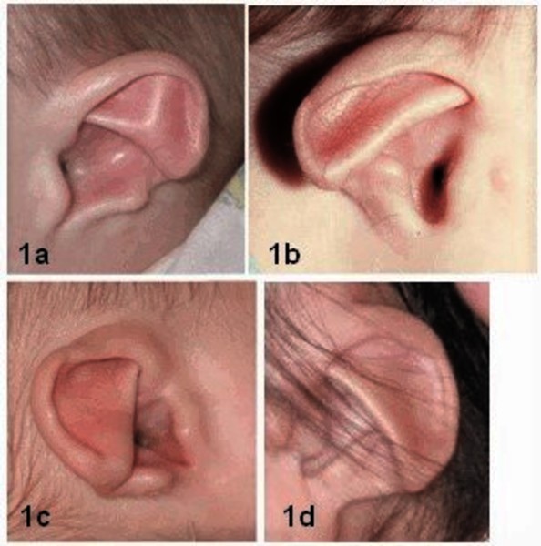 CHARGE Syndrome MedlinePlus Genetics CHARGE Syndrome MedlinePlus Genetics