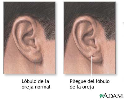 Pliegue Del L bulo De La Oreja MedlinePlus Enciclopedia M dica Pliegue Del L bulo De La Oreja MedlinePlus Enciclopedia M dica